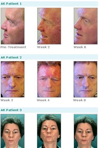 Sterling Minerals® Skin Care Guide Skin Cancer Revisitedefudex
