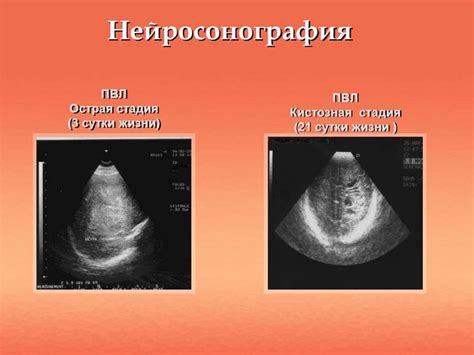 Гипоксически ишемические поражения головного мозга у новорожденных