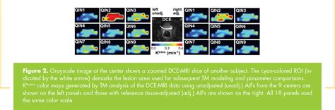 Figure 2 From The Impact Of Arterial Input Function Determination Variations On Prostate Dynamic