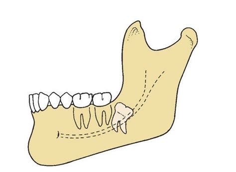 Difficult Impaction Case Medizzy