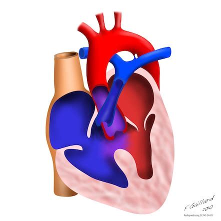 Tetralogy Of Fallot Radiology Reference Article Radiopaedia Org