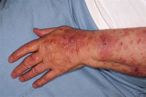 Celiac Disease Quiz Doquizzes