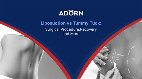 Six Pack Abs Liposuction Get Your Definition