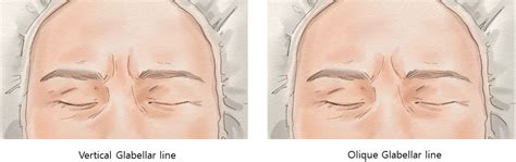 Glabellar Dynamics Decoded To Refine Precision In Botulinum Toxin