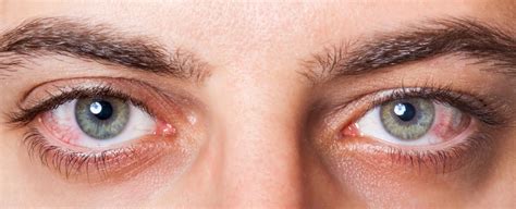 ¿conjuntivitis Identifica Sus Síntomas Y Cómo Evitarla
