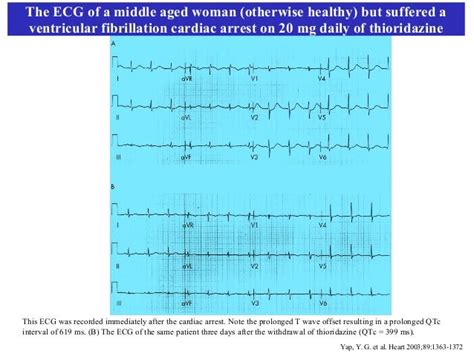 Drug Induced Qt Prolongation