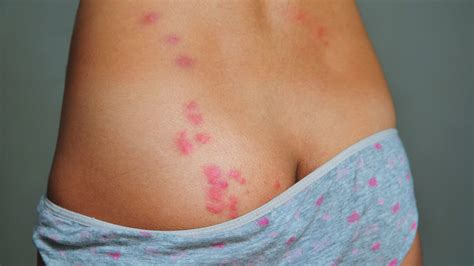 Bed Bug Bites On Back