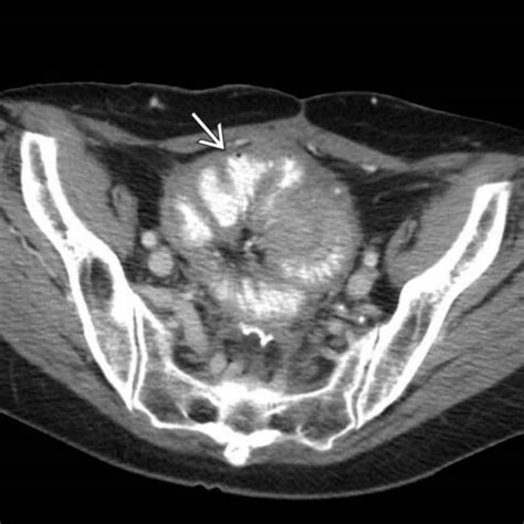 Small Bowel Obstruction Clinical Gate