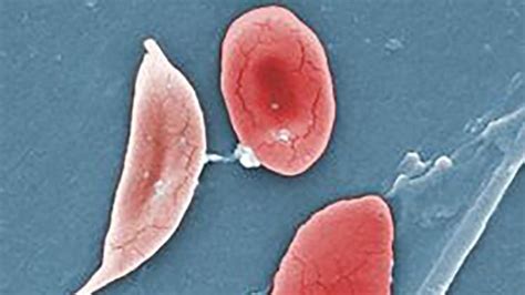 Nih Researcher Presents Encouraging Results For Gene Therapy For Severe