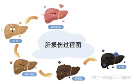 从肝炎到肝癌到底有多远？肝癌三部曲，走法不同结局各异 知乎