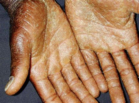 Why You Should Treat Xerosis Seriously This Dry Skin Condition Is Not A Joke Naturalhealth