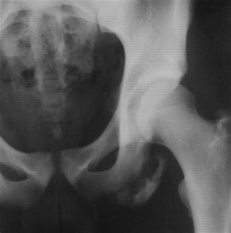 Hamstring Injuries Knee And Sports Orthobullets