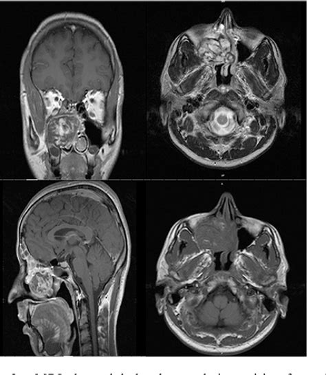 Figure 2 From Maxillary Sinus Hematoma Current Pathogenesis And