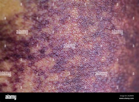 Asian Woman Dark Bruise On The Buttocks From A Slip Accident In The
