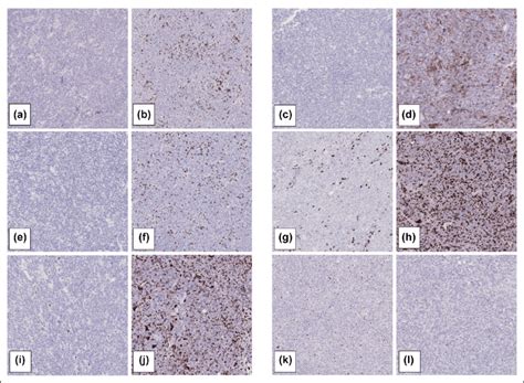 Examples Of Immunostaining Patterns Granzyme B Staining Low Five Download Scientific Diagram