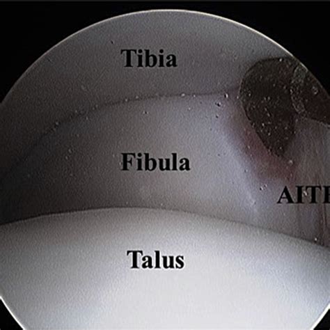The Posterior Inferior Tibiofibular Ligament Pitfl Provides Most Of