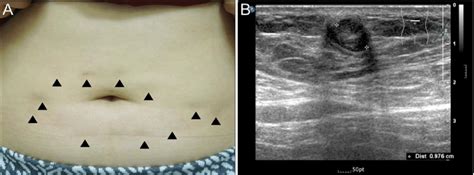 A Multiple Subcutaneous Nodules On The Abdomen B Ultrasonographic Download Scientific