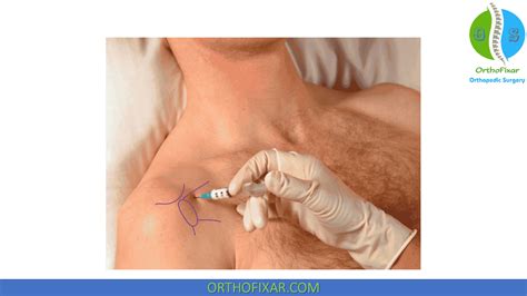 Subscapular Injection Easily Step By Step Orthofixar