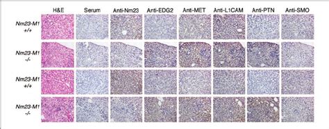 Nm23 H1 Expression Inversely Correlates With Met Edg2 Smo And Ptn