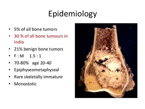 Giant Cell Tumour Of Bone
