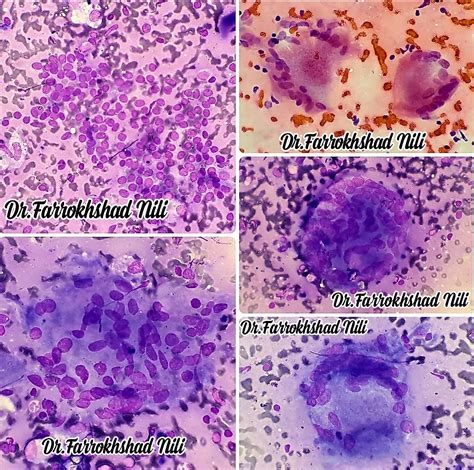 Farrokhshad Nili On Linkedin Thyroid Nodule Aspiration F N A 33 Y O Female With Rt Thyroid
