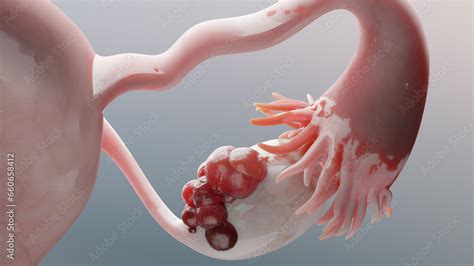 Ovarian Malignant Tumor Female Uterus Anatomy Reproductive System