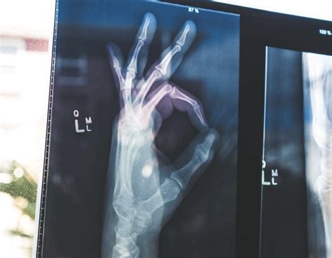The Bone Gut Axis A Revolutionary Approach To Predicting Osteoporosis