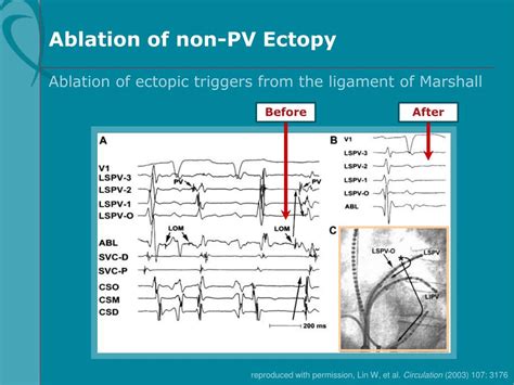 Ppt Section Iii Catheter Ablation For The Treatment Of Afib
