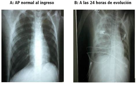 Figura 1 Rx Tórax Del Caso Clínico 2