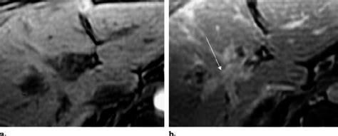 Intrahepatic Cholangiocarcinoma In A 69 Year Old Man A Axial Download Scientific Diagram