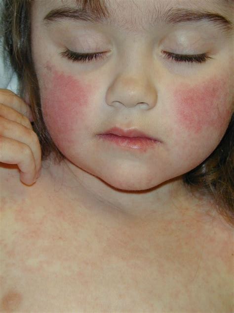 Fifths Disease Blog2best