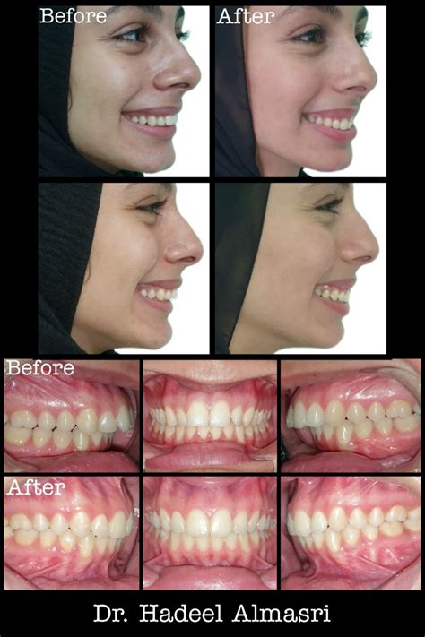 Hadeel Almasri On Linkedin Correction Of Class Ii Malocclusion In Young Adult Using Fixed