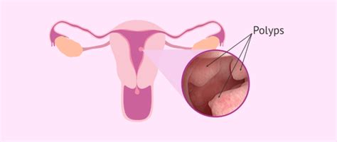 What Are Endometrial Polyps Symptoms Causes And Treatment