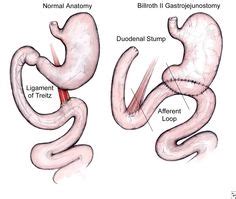 Types Of Partial Gastrectomies Billroth 1 Gastroduodenostomy
