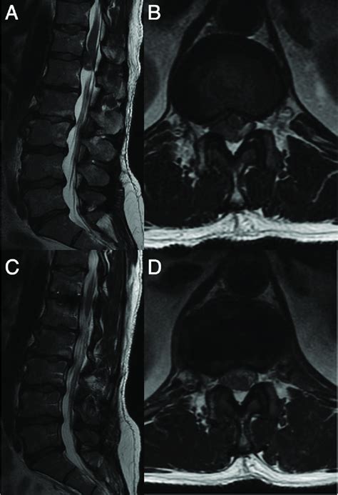 Preoperative Sagittal A And Axial B T2 Weighted Magnetic Resonance