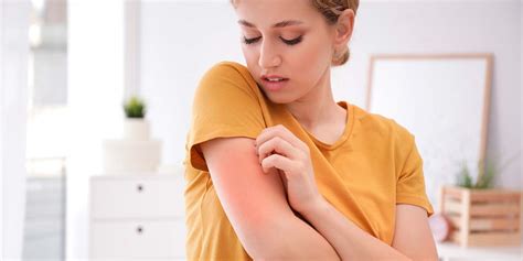Tratamiento Urticaria Síntomas Y Tipos Caser Seguros