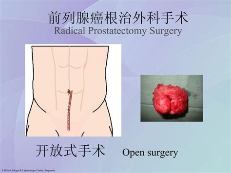 Urinary Problems In Aging Male Chinese Ppt