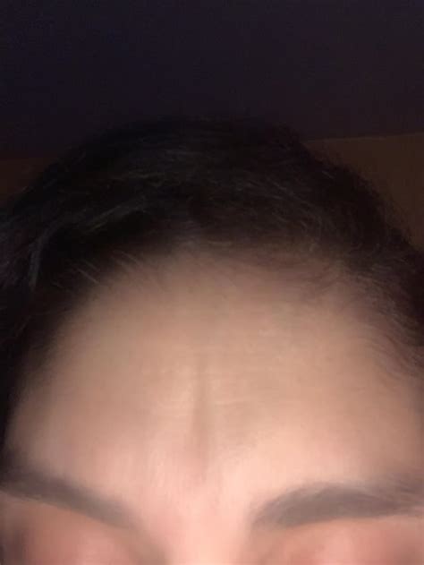 Does This Look Like Linear Scleroderma I Have Systemic Scleroderma