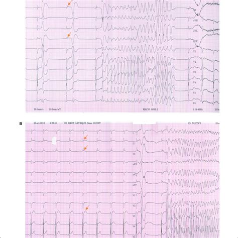 Ecg Of Patient Nr 2 Presenting With Early Repolarization Syndrome J Download Scientific