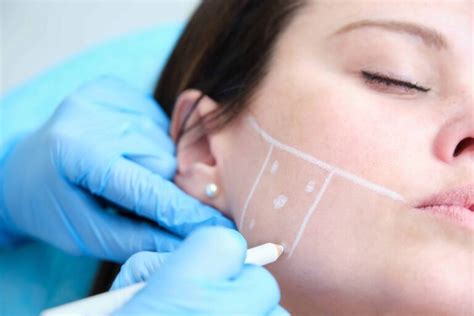 How Long Masseter Botox Takes To Work Results Timeline And What To Expect