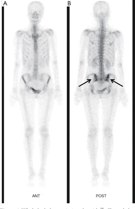 Figure 2 From Bone Marrow Reconversion Mimicking Pelvis Metastases In A Patient With Rectal