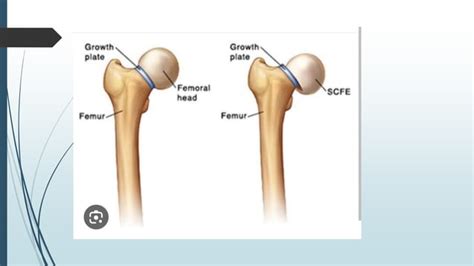 Slipped Capital Femoral Epiphysis Pptx