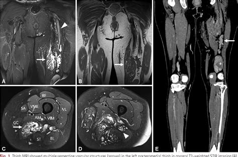 Figure 1 From A Case Of Focal Myopathy With Neuropathy Caused By