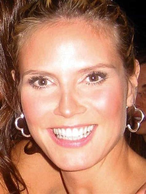 Celebrities With Strabismus List Of Famous People With Lazy Eyes