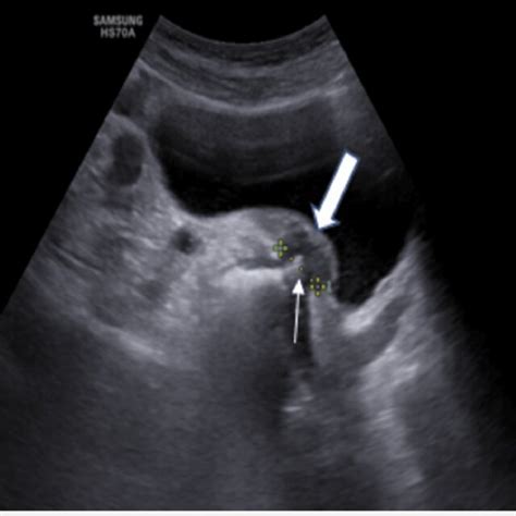 Ultrasonography Axial Section Through The Urinary Bladder Shows A