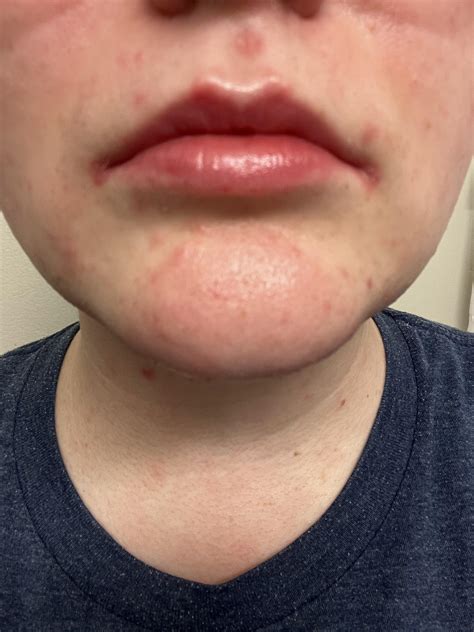 Red Bumps On Lips Came Out Of Nowhere Rskincareaddiction