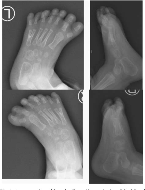 Figure 2 From Surgical Management Of Bilateral Preaxial And Postaxial