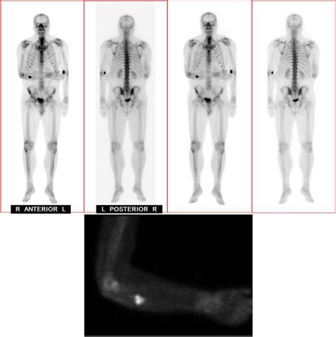 Total Body Tc99 Nuclear Medicine Bone Scan At Presentation Shows Download Scientific Diagram