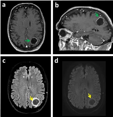 Figure From Diagnosis Of Glioblastoma By Immuno Positron Emission Tomography Semantic Scholar