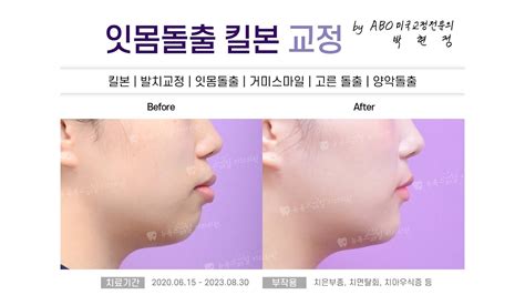 창원울산대구 킬본교정 잇몸돌출 킬본교정킬본발치교정잇몸돌출거미스마일고른 돌출양악돌출banda Abo미국교정